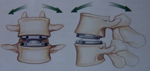 Una alternativa a la fusión lumbar | Michael Thallium